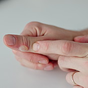 Hands, boil and dermatology with swelling, man and inflammation with ...